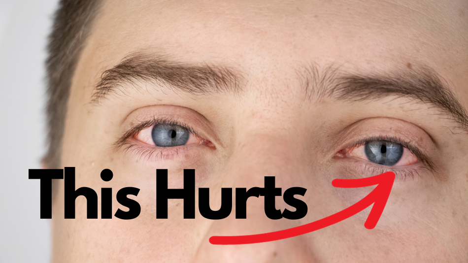 How to Treat Welders Eye – A Complete Guide For Beginners